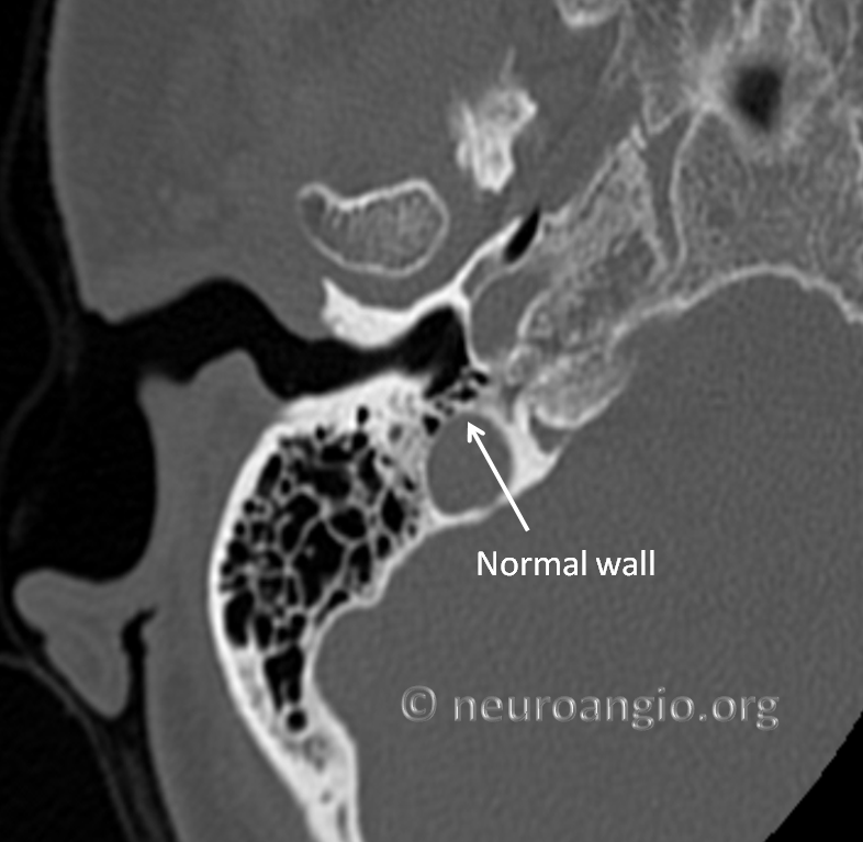 Pulsatile Tinnitus Jugular Plate Dehiscence | neuroangio.org